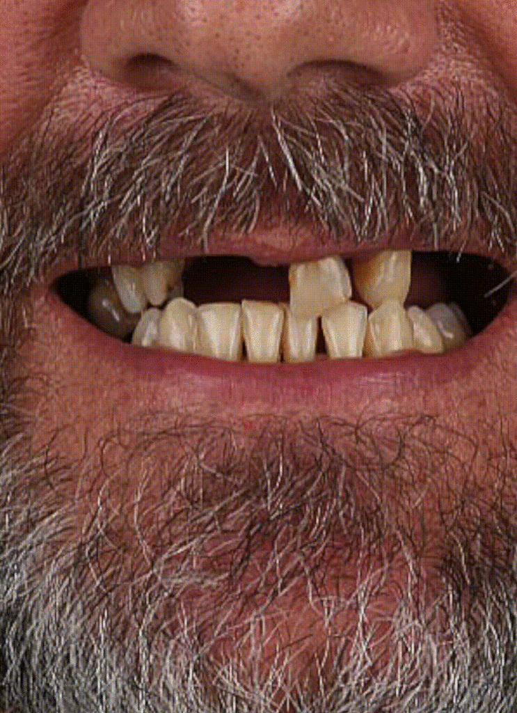 Before & Afters - Chicago Implant Studio
