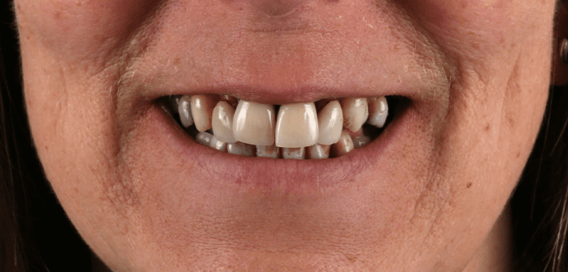 Dental Implant Abutments Explained - A Comprehensive Guide - Chicago ...