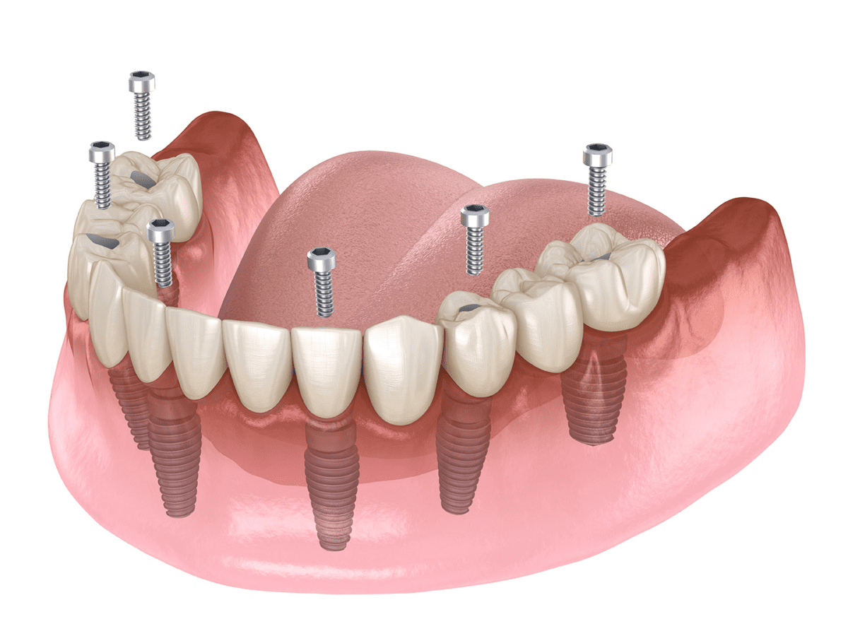 Dental Implant Post-Operative Care: A Comprehensive Guide