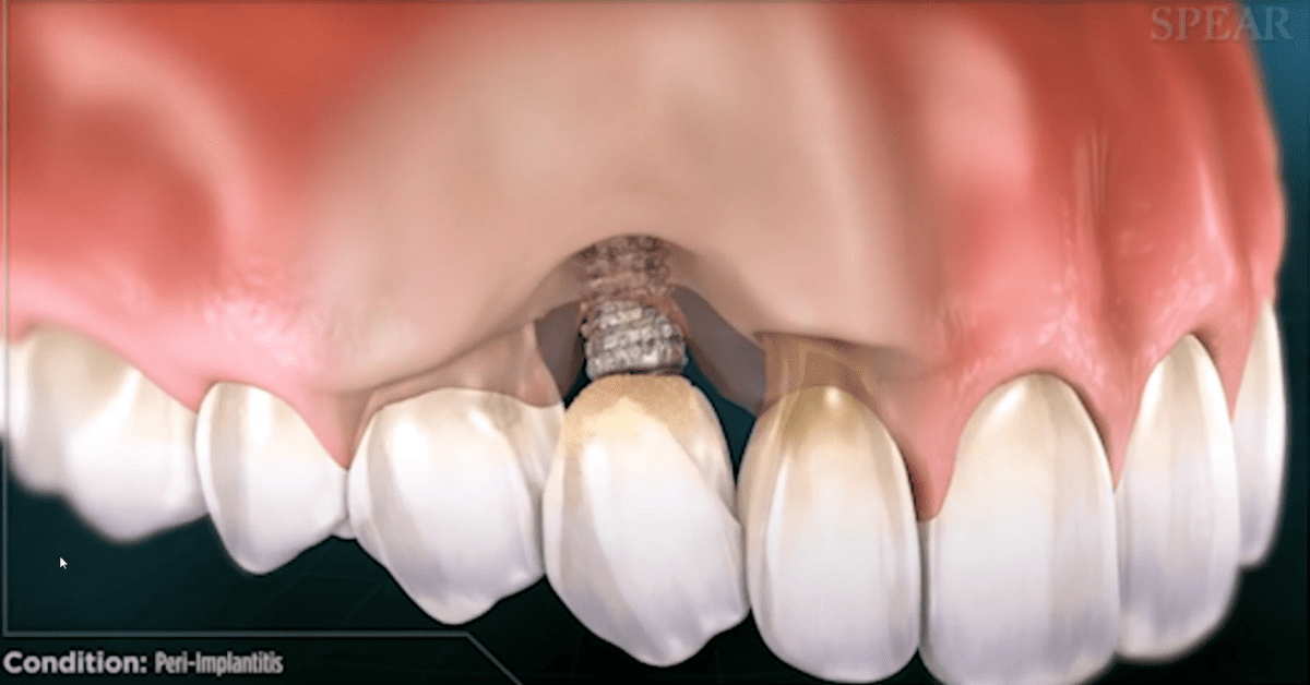 Signs of Dental Implant Rejection and Failed Dental Implant Symptoms ...