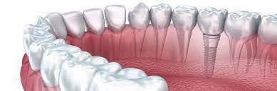 Dental Implant Surgery: Understanding the Duration of Postoperative ...